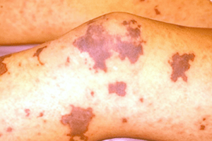 Meningitis in Children - Pediatric Medical Experts