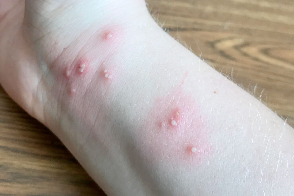 Creepy Crawlers Part 2: Spiders, Bees & Ants - Pediatric Medical Experts