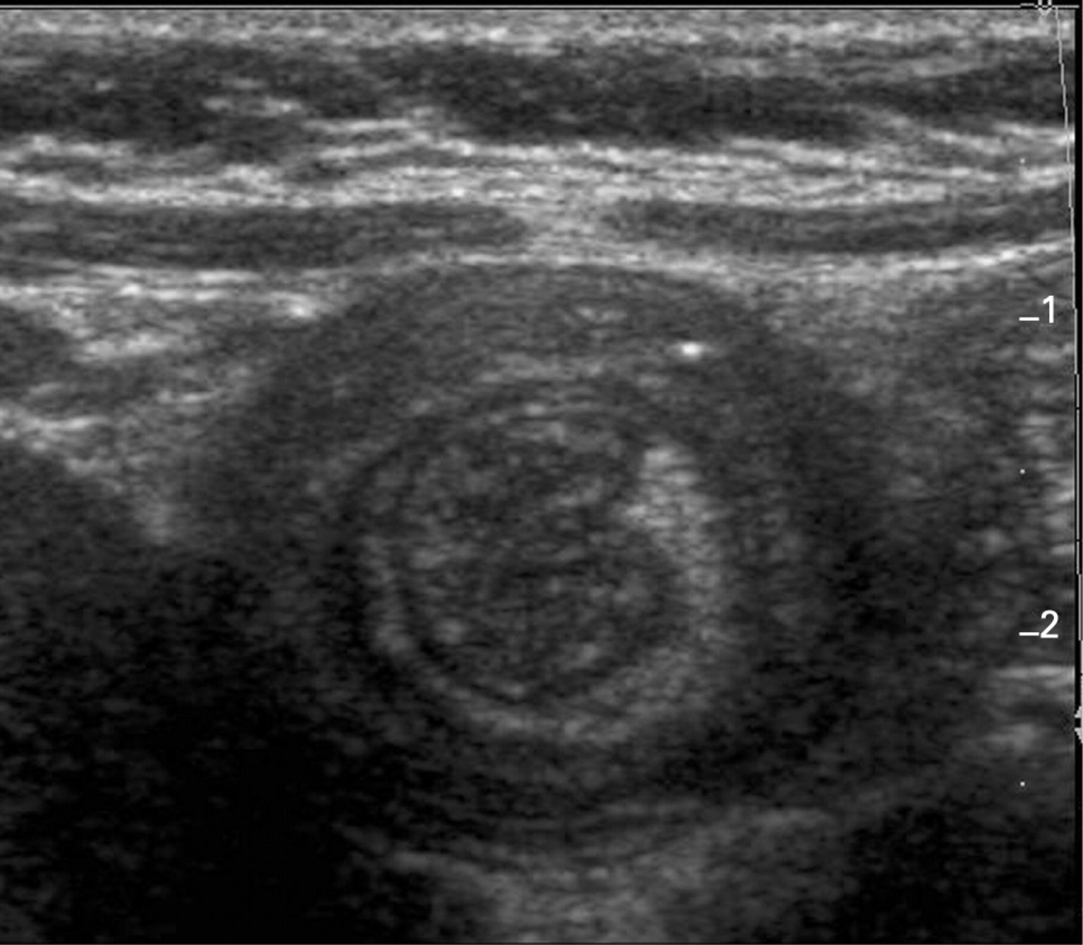 Abdominal Pain Part III: Acute Abdominal Pain, Surgical Emergencies ...