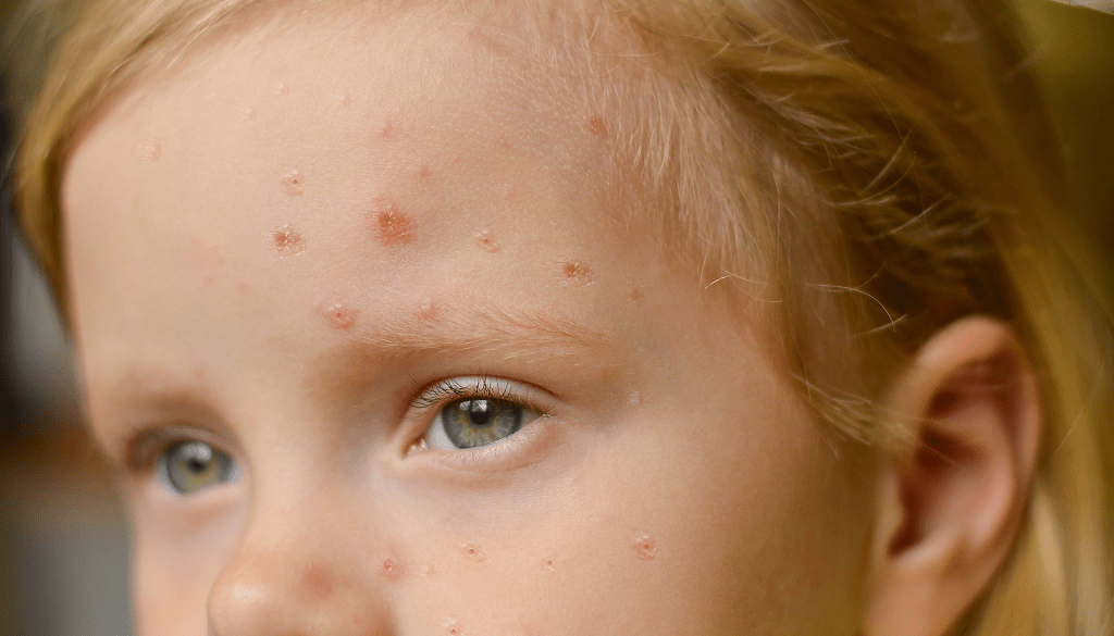 Monkeypox and the Impact of Pediatric Infections - Pediatric Medical ...