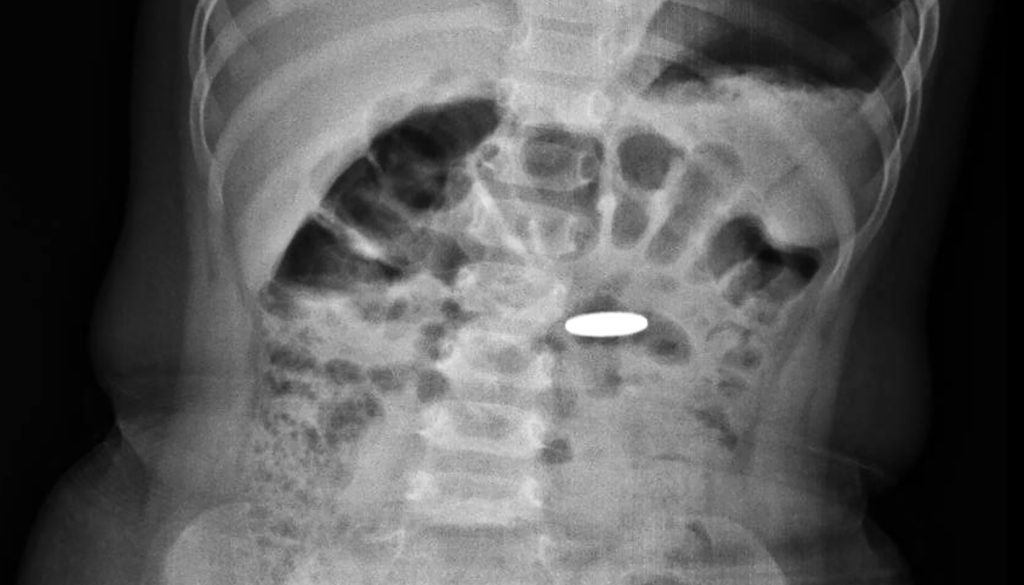 Foreign Body Ingestion: What Needs to Come Out! - Pediatric Medical Experts
