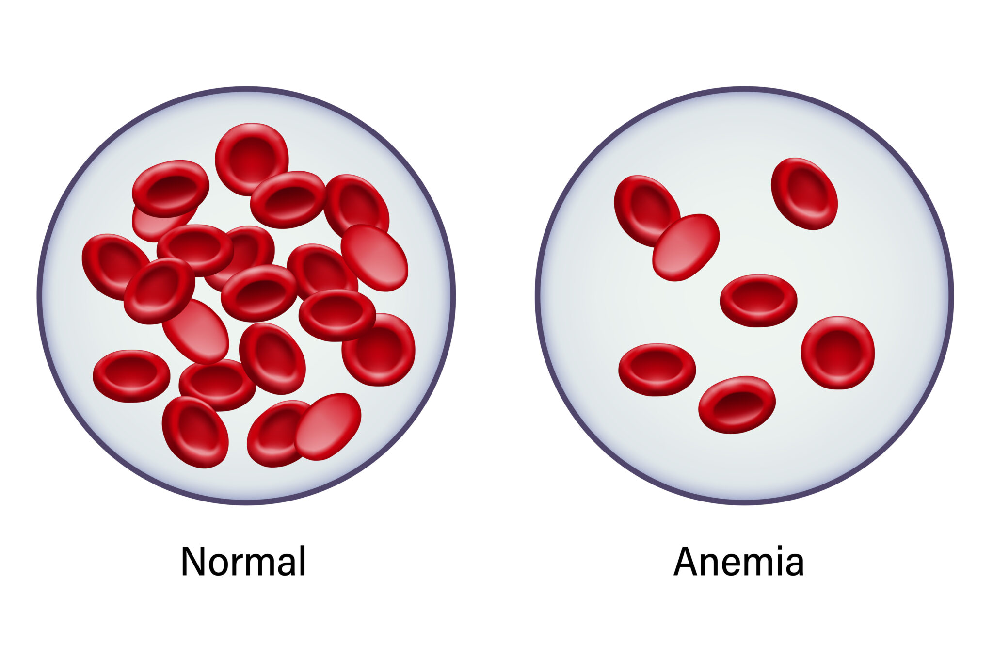Iron Deficiency Anemia - Pediatric Medical Experts